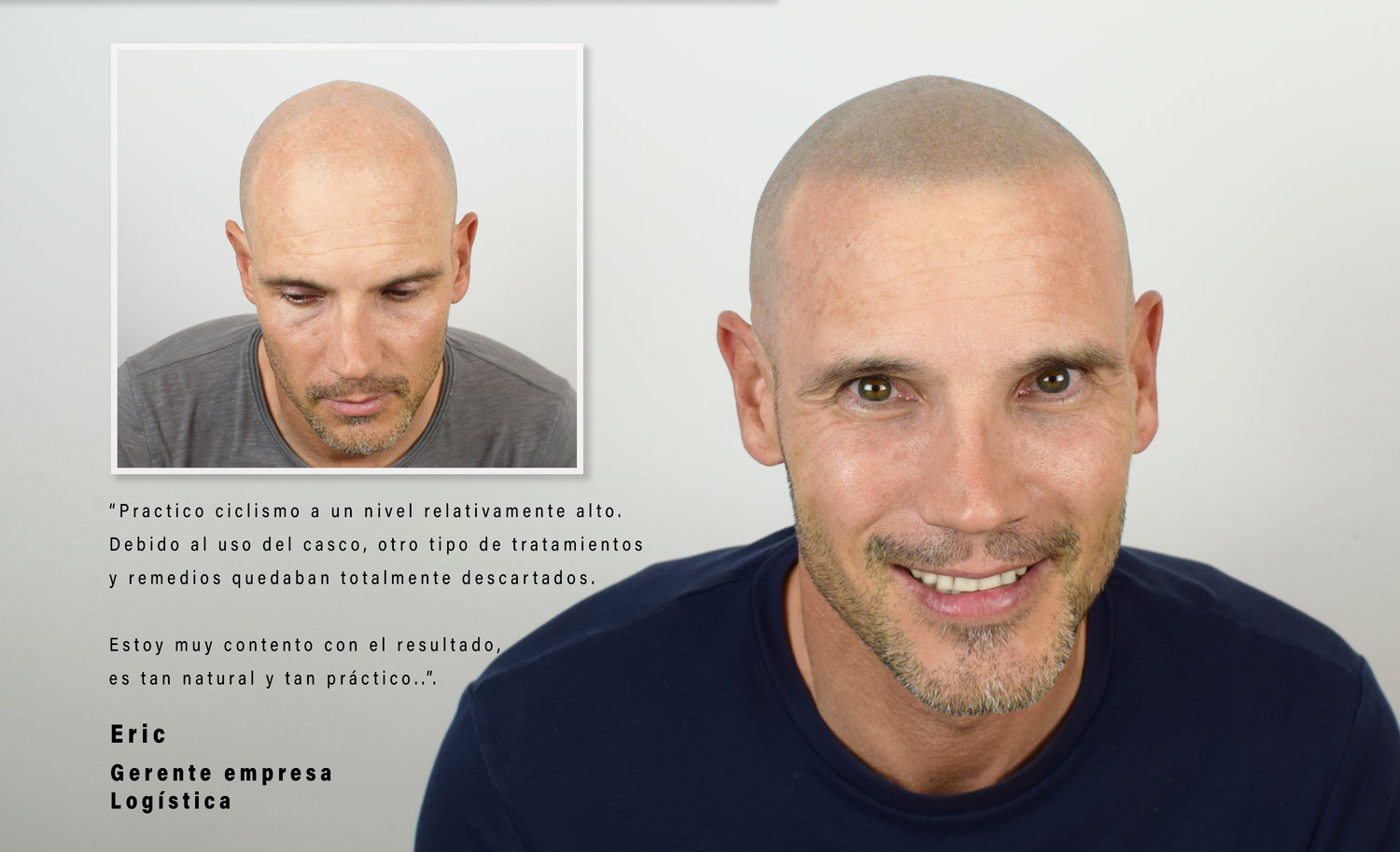 NEW HAIR SOLUTIONS | Micropigmentación Capilar Avanzada